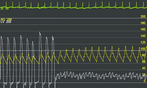 3 Hemodynamic Tracing In The Cathlab In A Patient With Rheumatic Download Scientific Diagram