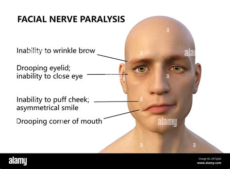 Bells Palsy A Unilateral Facial Paralysis Computer Illustration The