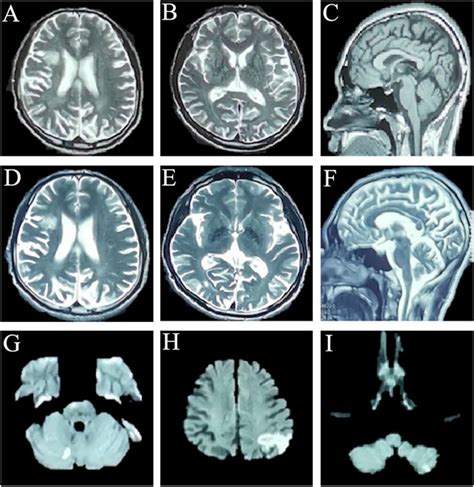 Intraparietal Sulcus Mri