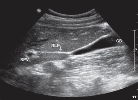 Gallbladder Quiz 6 Flashcards Quizlet