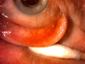 Conjunctival Concretions Eyewiki