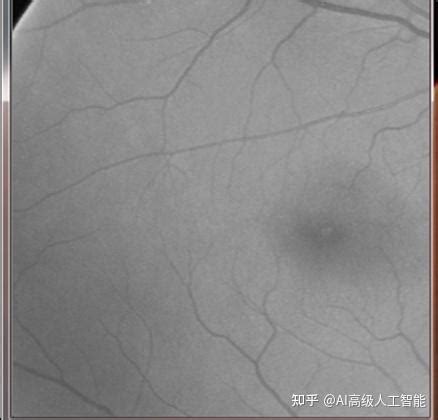 基于机器视觉的视网膜血管和黄斑分割识别 知乎