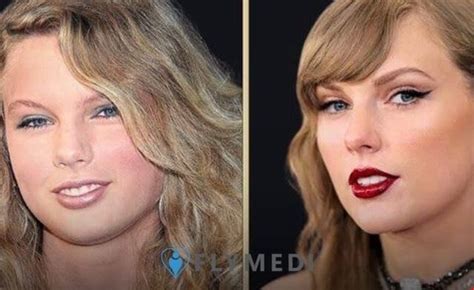 Taylor Swift Nose Job Rumors Istanbul Surgeons Analyze The