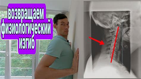 ЧЕМ ОПАСЕН СГЛАЖЕННЫЙ ШЕЙНЫЙ ЛОРДОЗ упражнения Lordosis Exercise Youtube