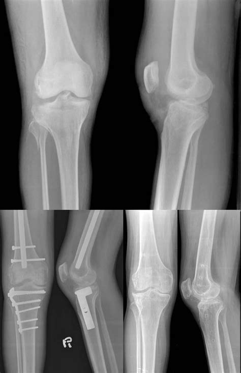 Tib Fib Fracture Classification Aslofull