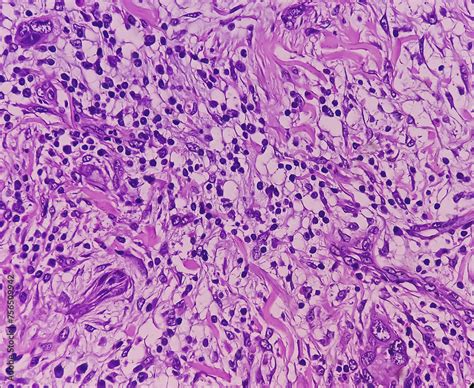 Tissue From Axilla Biopsy Invasive Squamous Cell Carcinoma Smear