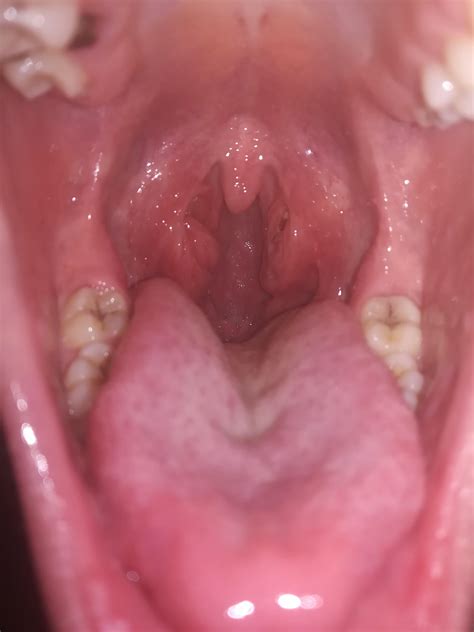 Do My Tonsils Look Normal Rtonsilstones