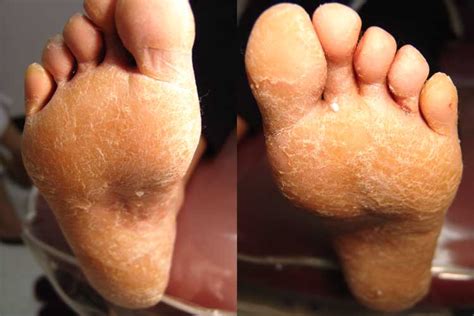 Palmoplantar Keratosis The Foot And Ankle Online Journal