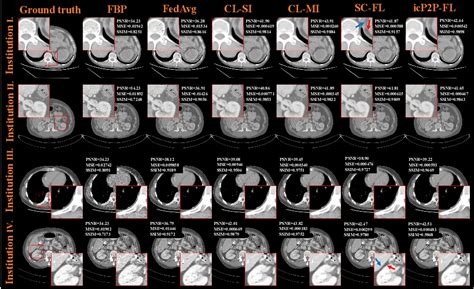 Figure 2 From A Peer To Peer Federated Continual Learning Network For Improving Ct Imaging From