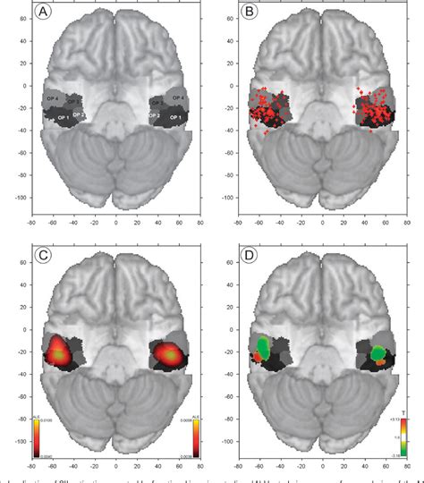 Figure 1 From The Human Parietal Operculum Ii Stereotaxic Maps And
