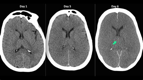 Pseudosubarachnoid Sign On Ct Brain Scan Youtube