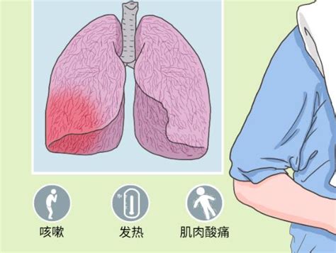 感染肺炎能自愈吗 肺炎多长时间能好彻底 大众健康网