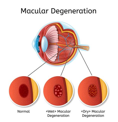 Dry Macular Degeneration