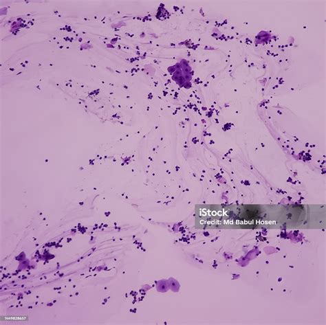 소변 현미경 검사 소변 세포학 자궁 경부 세포진 염색의 현미경 사진 상피 세포 호중구 및 가끔 조직 구를 보여줍니다 Pap