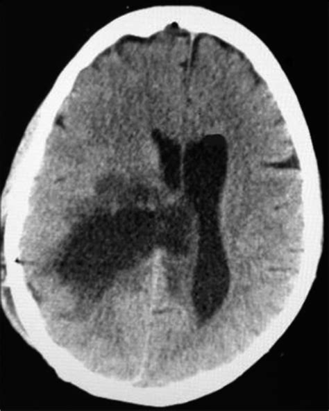 Surgical Neurology International