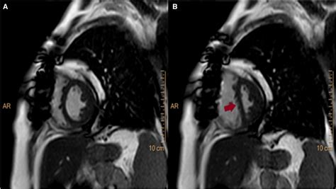 Pathophysiological Concepts Of Constrictive Pericarditis In Cardiac