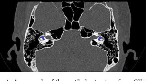 Figure 1 From Hybrid Deep Feature Fusion Of 2d Cnn And 3d Cnn For Vestibule Segmentation From Ct