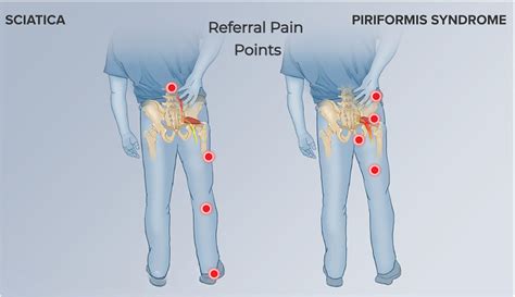 Understanding Piriformis Syndrome Vs Sciatica And The Role Of Remedial
