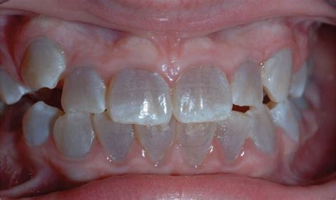 Teeth Gray Conditions And Its Treatment