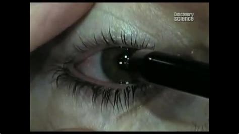Как это работает лазерная хирургия глаза porn video on BrownPorn