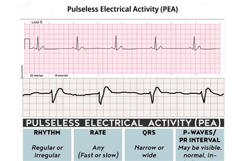Pulseless Electrical Activity Cardiac Arrest And Resuscitation Willnice