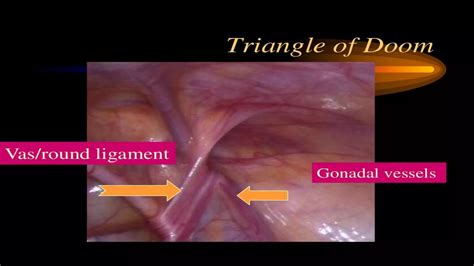 Laparoscopic Anatomy Of Inguinal Hernia Ppt
