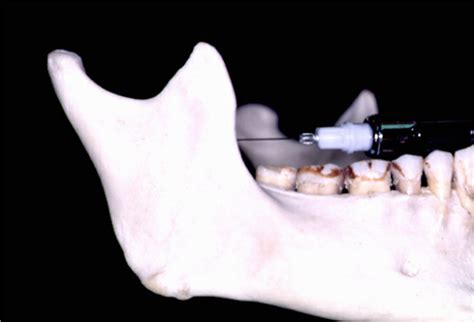 Buccal Dental Block At Joshua Allingham Blog
