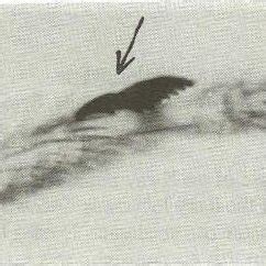 Example Of A Sex Comb Of Ix Ix Male Note That Download Scientific Diagram