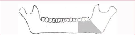 Unilateral Angle Body Mandibulectomy At Right Or Left X Download Scientific Diagram