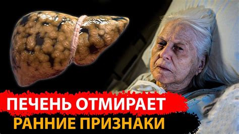 5 ранних Признаков ОТМИРАНИЯ ПЕЧЕНИ 90 с проблемами печени даже не знают об этом Youtube