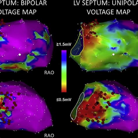 E Representative 3 Dimensional Electroanatomic Maps From Three Patients