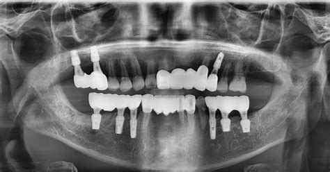 주안동임플란트 빠르고 안아프고 정확하게 연세오늘치과 네이버 블로그