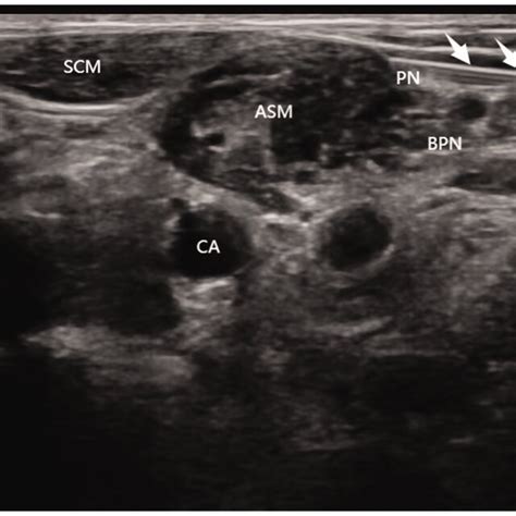 Pdf Phrenic Nerve Block Combined With Stellate Ganglion Block For Postoperative Intractable