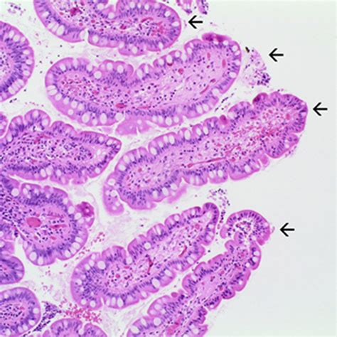 Colon Biopsy From The Colonoscopy The Pathology Report Describes