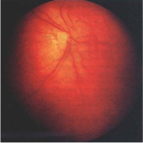 Left Fundus Hypopigmentation Download Scientific Diagram