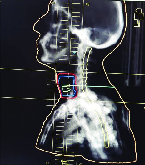 Showing The Computed Tomography Based Plan Download Scientific Diagram
