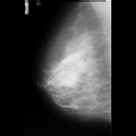 Mammography Segmentation Download Scientific Diagram