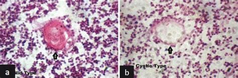 Solid And Cystic Types Of Hassalls Corpuscles Hande Staining ×40