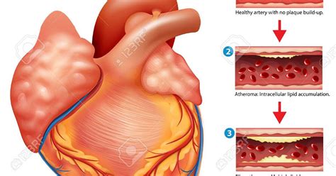 Arteriosklerosis Pendidikan Kesehatan