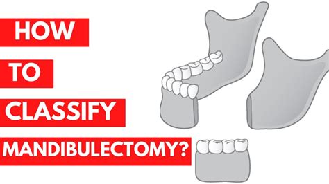 Classification Of Mandibulectomy Cantor And Curtis Youtube