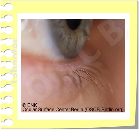 GLIMPSE On The LID MARGIN Ocular Surface Center Berlin