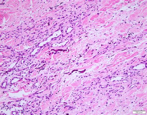 Pathology Outlines Calciphylaxis