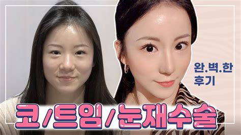 성형vlog 😶꼬막눈 탈출 후기 Feat 화려한 코 코성형후기 성형브이로그 트임수술 앞트임 뒷트임 밑트임