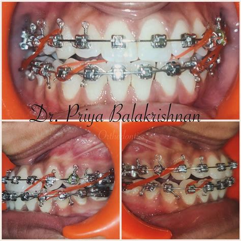 Drpriya Balakrishnan On Linkedin Midline Correction With Elastics