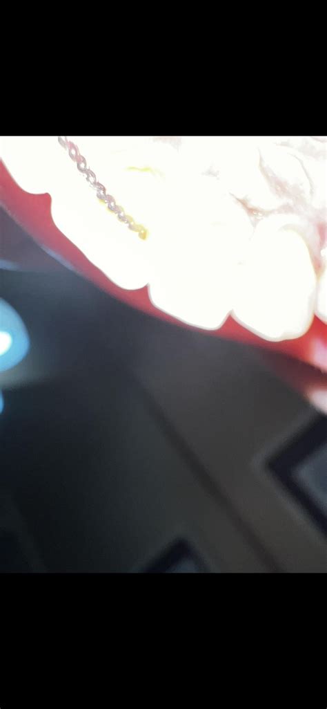 Permanent Retainer Bent R Braces