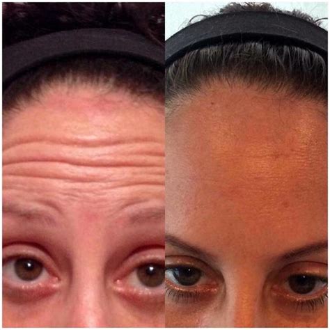 Botox Before And After Pictures Forehead 4 Facelift Info Prices Photos Reviews Qanda