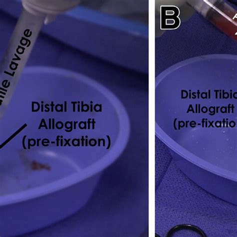 After Preparation Of The Distal Tibia Allograft The Graft Is Submitted Download Scientific