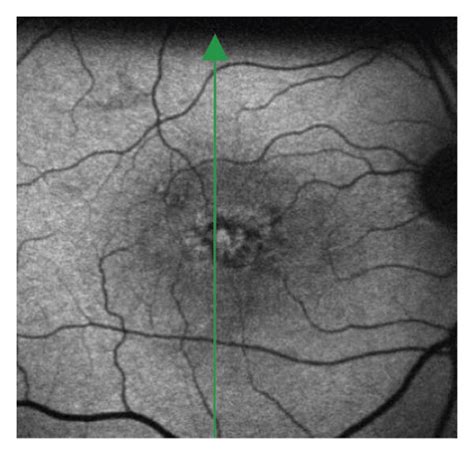 Effect Of Inverted Ilm Flap Technique On Macular Hole In Imh Patients Download Scientific