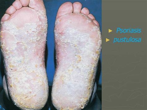 Psoriasis Classification Of Psoriasis