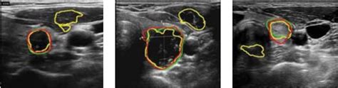 Figure 1 From Multi Task Learning For Thyroid Nodule Segmentation With